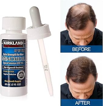 Kirkland Extra Strength for Men Tropical Solution 5% – ROMAC